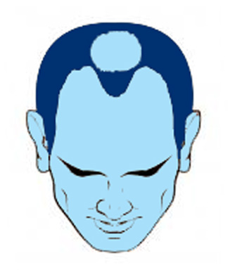 Finasteride - Dr. Hair