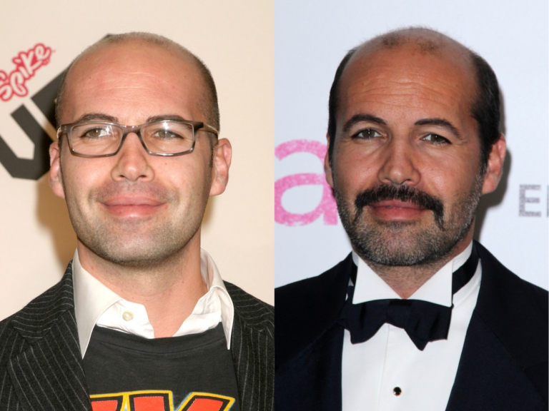 Stages Of Male Pattern Baldness: The Norwood Scale | DrHair