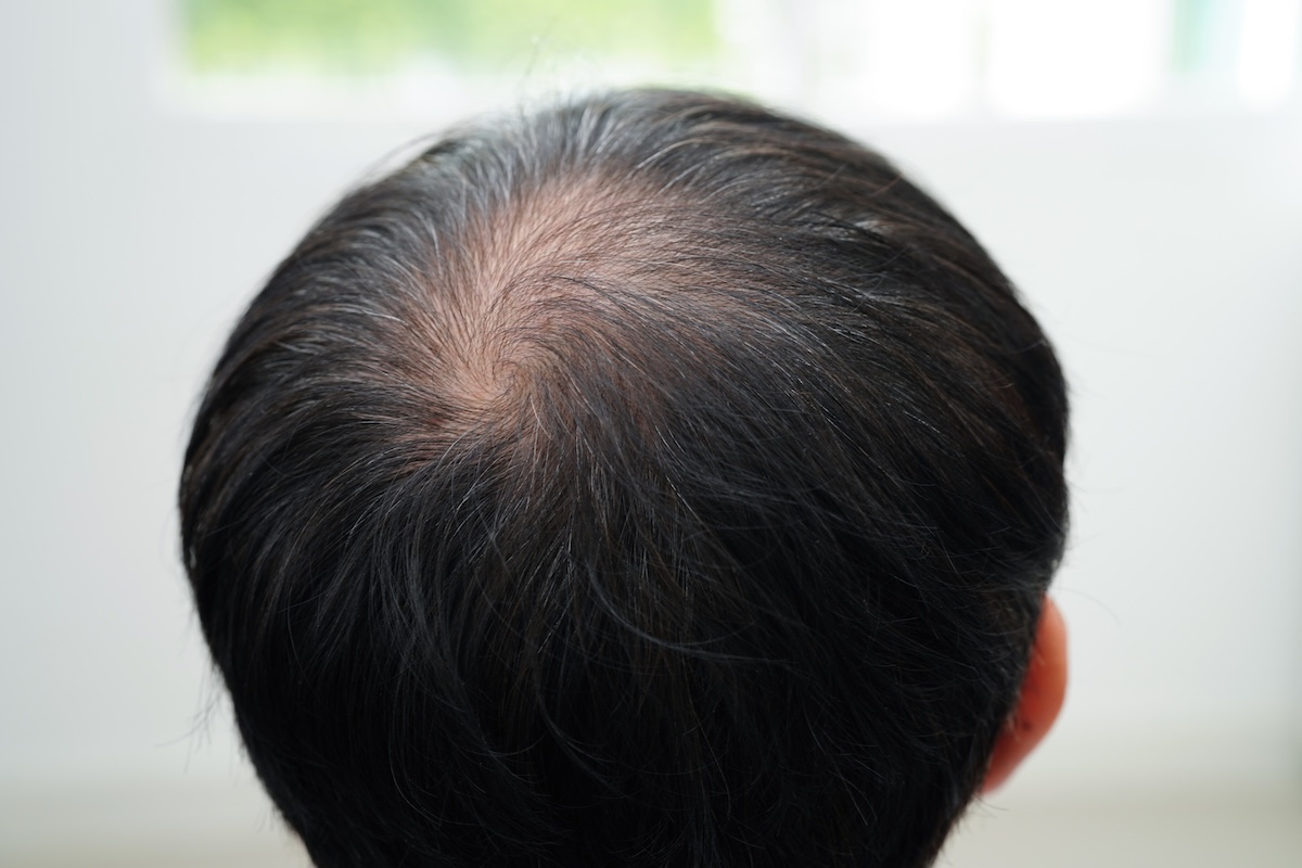 Stages Of Male Pattern Baldness: The Norwood Scale | DrHair