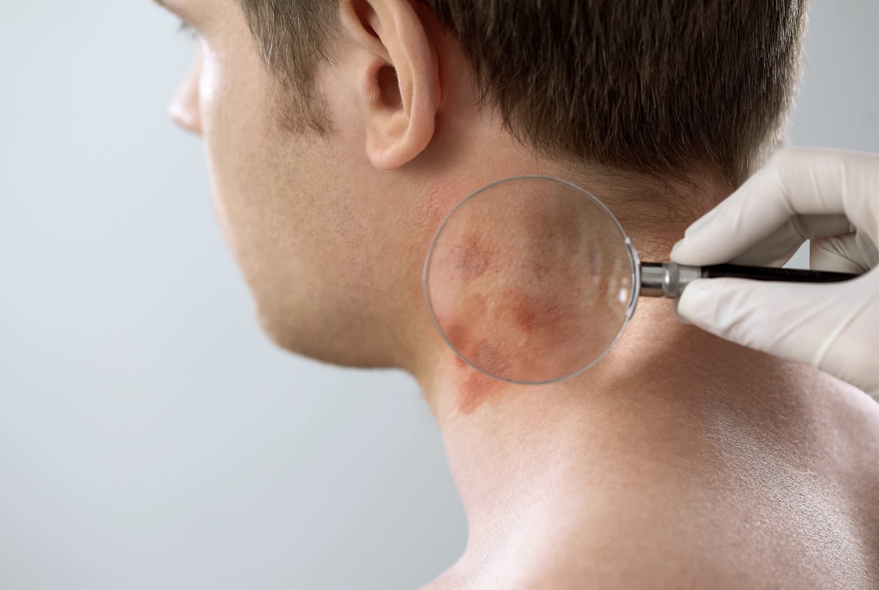 Can Minoxidil Cause A Rash? | DrHair