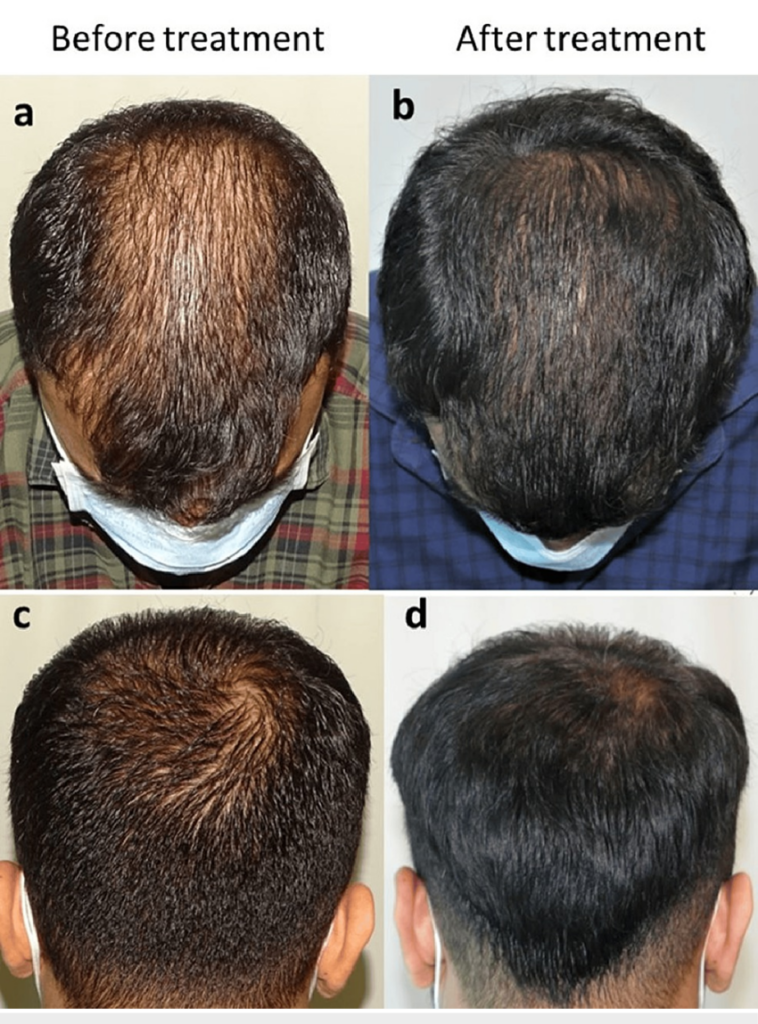 Finasteride & Minoxidil Results: What To Expect