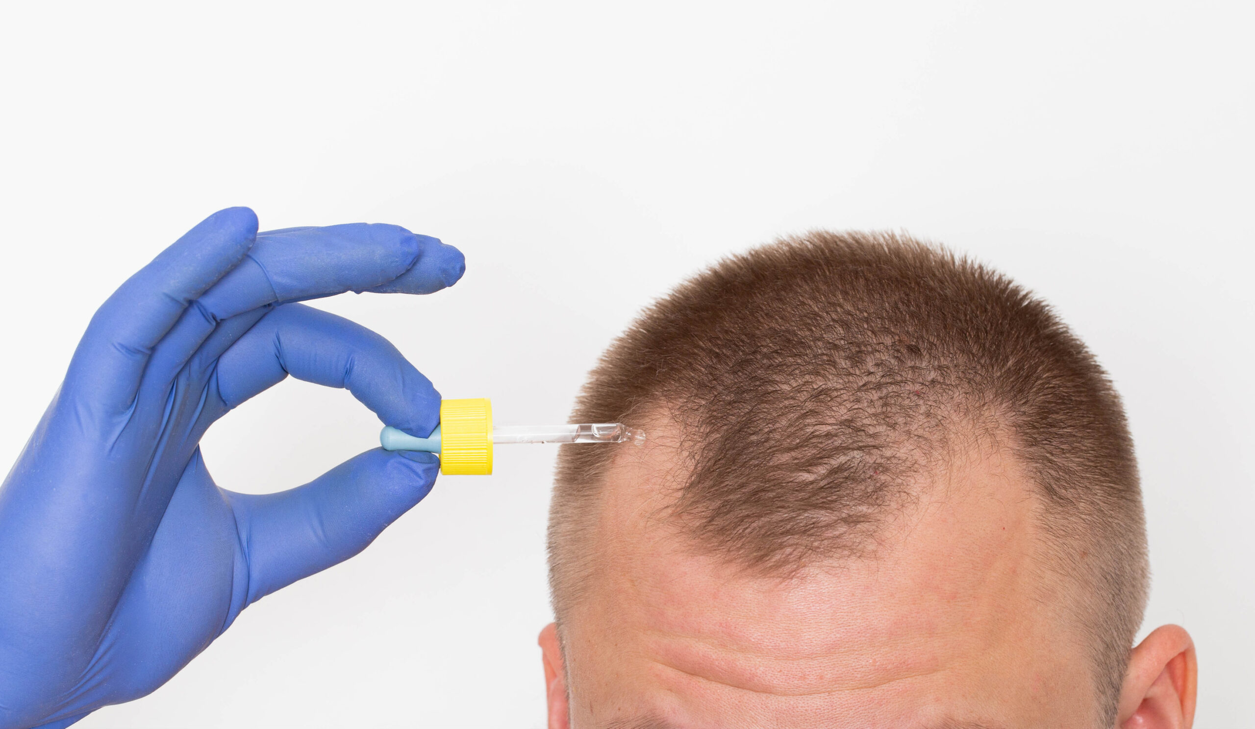 How To Apply Minoxidil For The Best Hair Growth Results