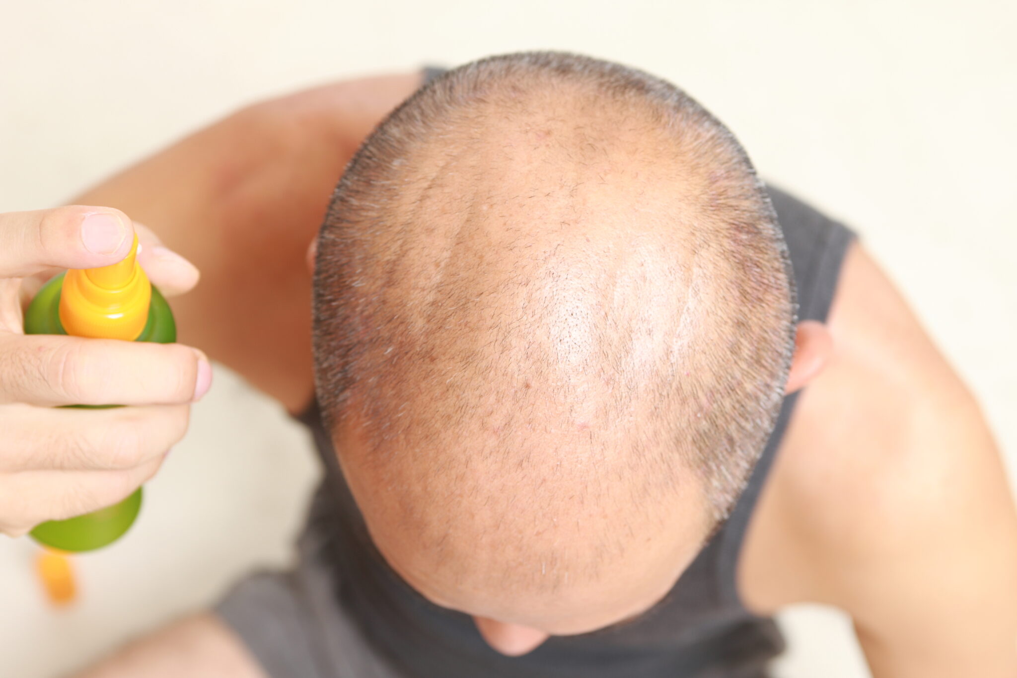 How To Apply Minoxidil For The Best Hair Growth Results