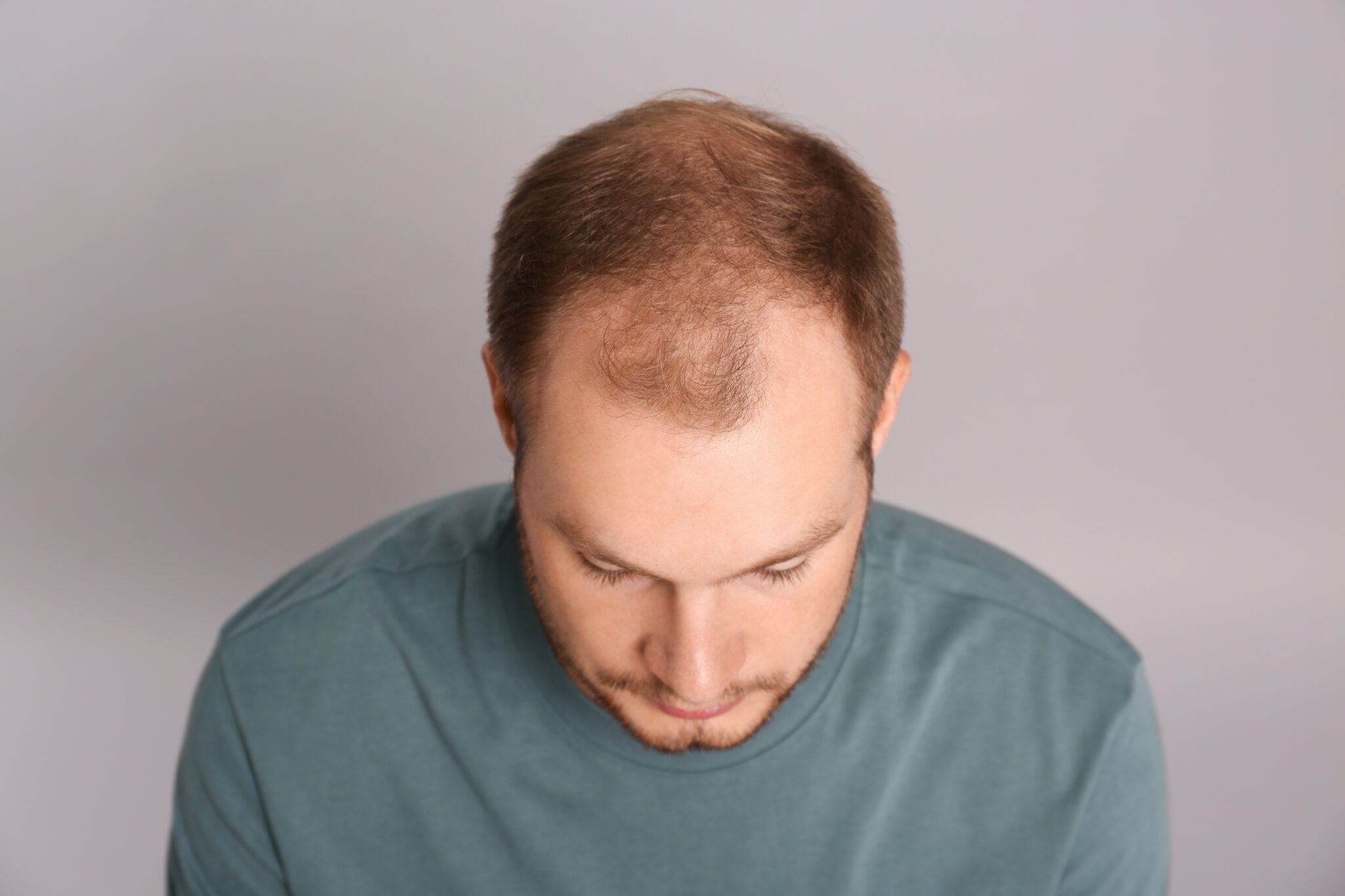 How To Recognise, Treat & Prevent Male Pattern Baldness