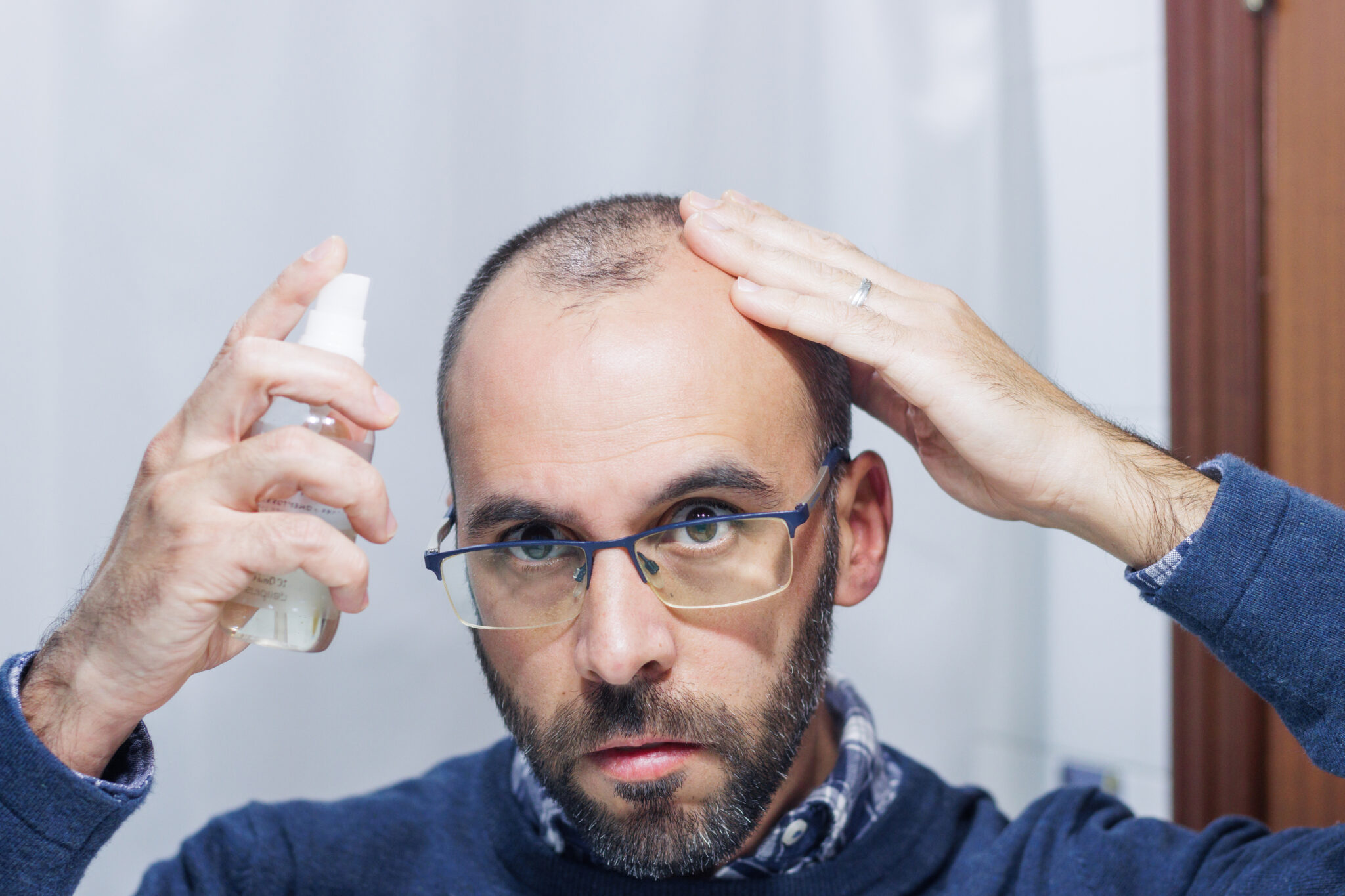 How To Recognise, Treat & Prevent Male Pattern Baldness