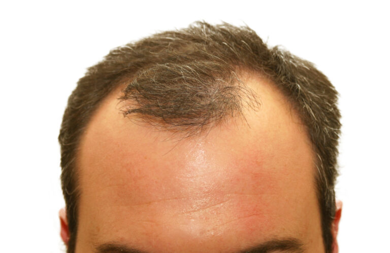 How To Recognise, Treat & Prevent Male Pattern Baldness