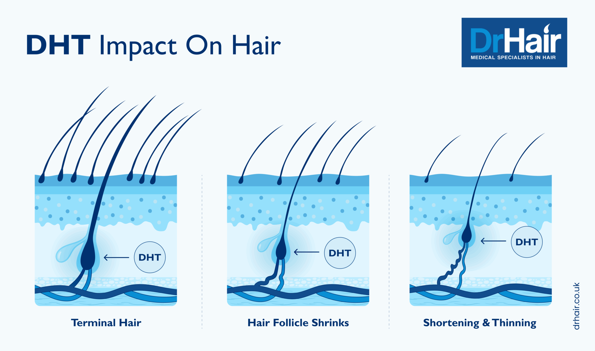 Are Finasteride Side Effects Permanent & Can You Avoid Them?