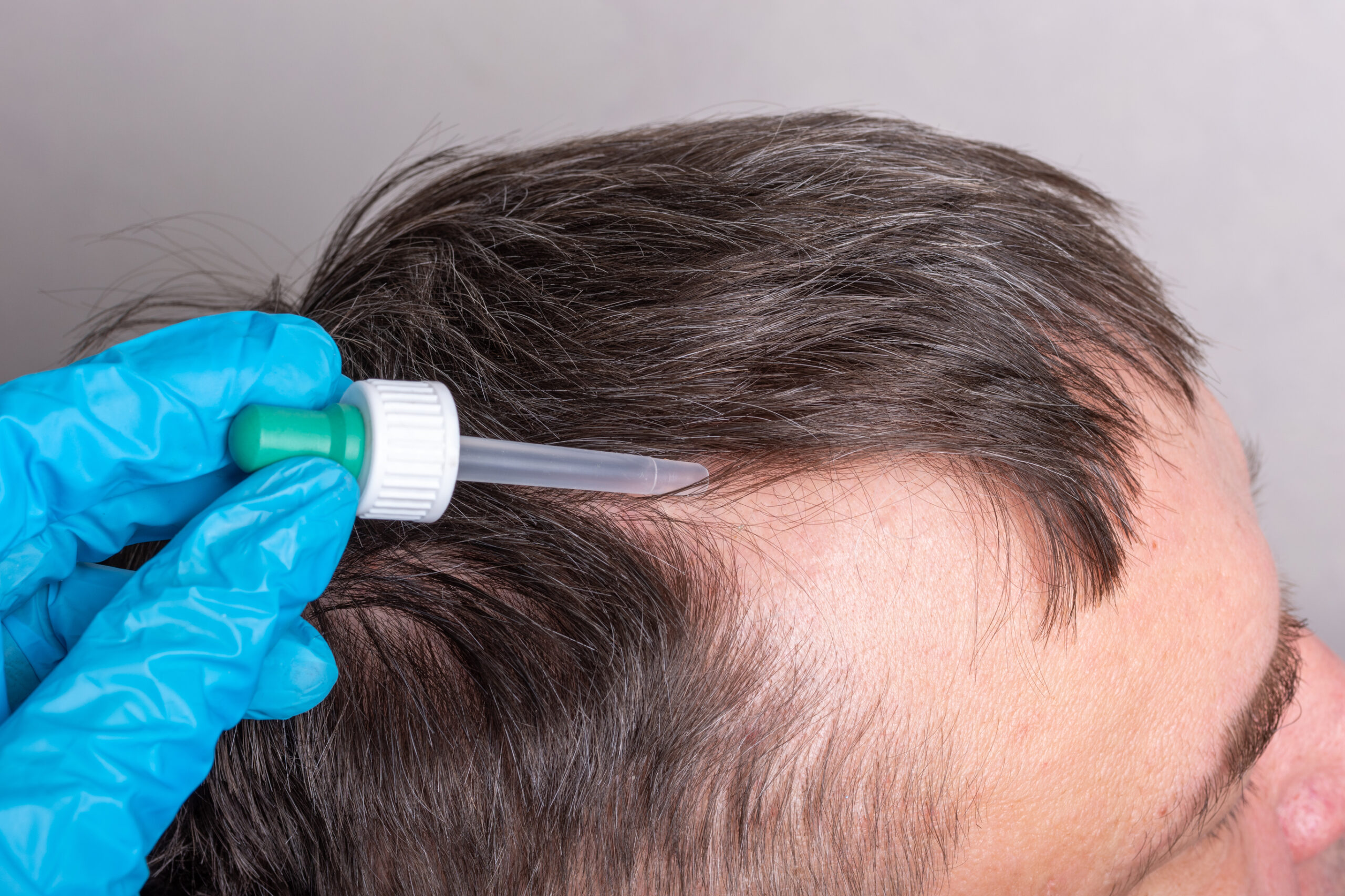 Topical vs oral finasteride: Which is the best?